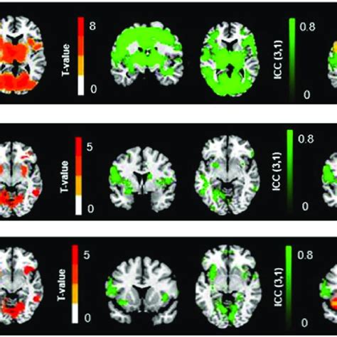 Overlaps Between Icc Maps And Group T Maps Top Brain Activation Download Scientific Diagram