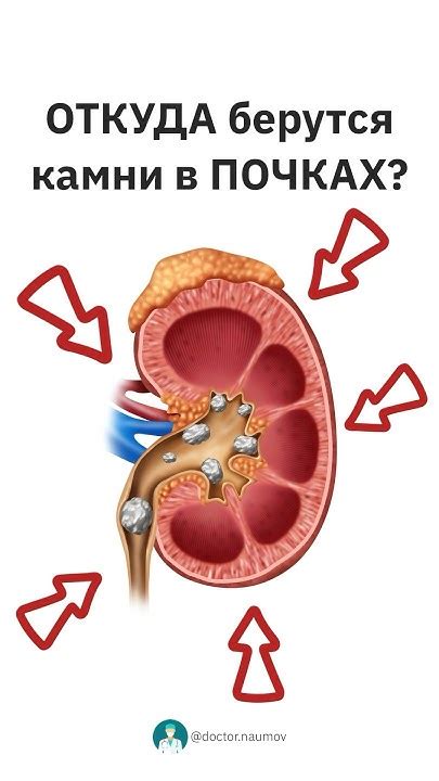 ОТКУДА берутся КАМНИ в почках анатомия почки урология Youtube