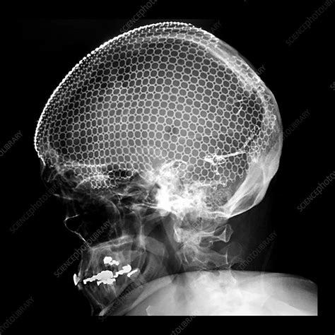 Mesh Cranioplasty X Ray Stock Image C039 4235 Science Photo Library