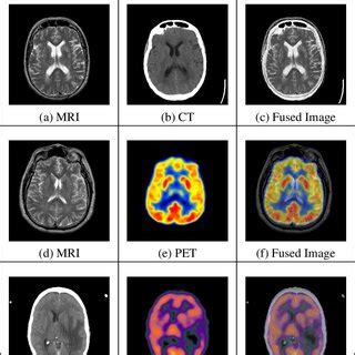 Examples Of The Common Combinations Of Multimodal Medical Image Fusion