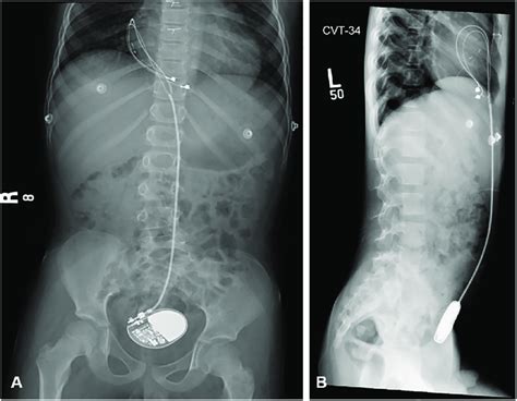 A Pacemaker Sitting In The Pelvic Cavity With Stretched Cable And Download Scientific Diagram