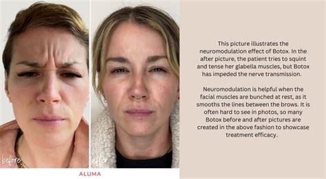 How Botox Works How Long It Lasts And How Safe It Is