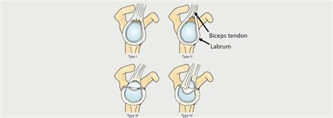 SHOULDER LABRAL TEAR MOTUS Physical Therapy