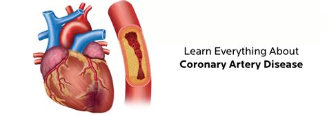 Learn Everything About Coronary Artery Disease Rbh