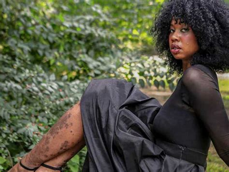 Why Fighting Psoriasis Is More Than Skin Deep