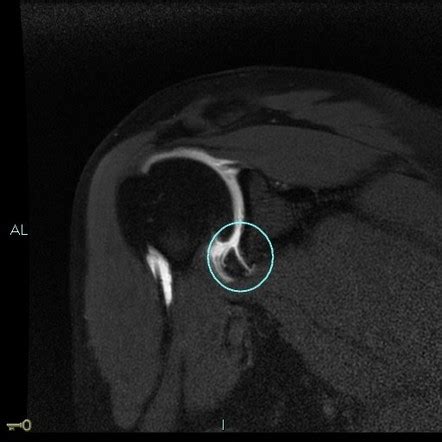 Bankart Lesions Sports Medicine Review