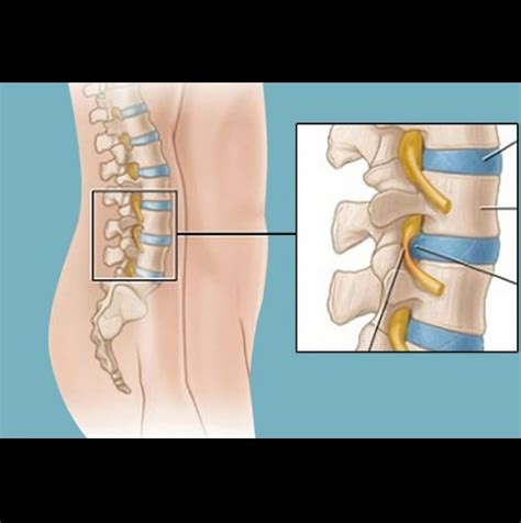 Хирург разубеди чичо ми за операция на дискова херния и му препоръча упражнения Шест месеца по