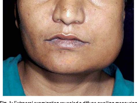 [pdf] Advancing Mandibular Swelling A Diagnostic Dilemma Semantic Scholar