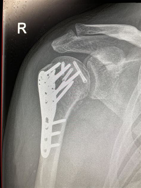 proximal humerus fracture r xrayporn
