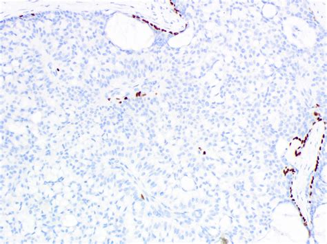Pathology Outlines Solid Papillary Carcinoma