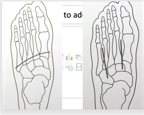 Metatarsus Adductus Deformity Flashcards Quizlet