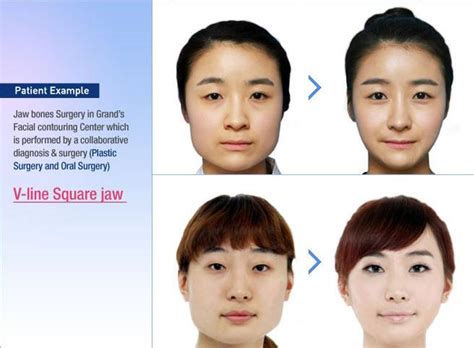 Grand Plastic Surgery How To Get A Small V Line Face