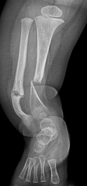 Pseudoartrosis Congénita De La Tibia