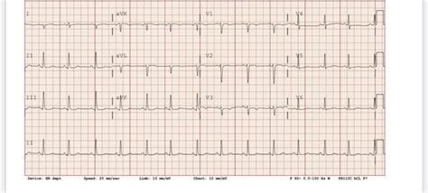 Chest Flutter Bangs At Rest Keeps Me From Sleeping Relaxing No Racing No Afib Holter Monitor