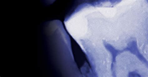 Understanding Irrigation In Endodontic Therapy Decisions In Dentistry