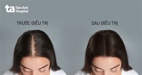 Rụng Tóc Nhiều Ở Nữ Là Bệnh Gì Nguyên Nhân And Cách Điều Trị Hiệu Quả