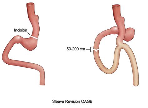 Sleeve Weight Regain Bariatric Surgery Ucla Health