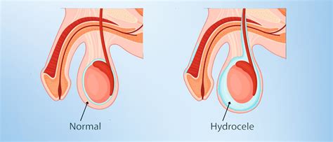 Hydrocelectomy Purpose Procedure Risks And Recovery