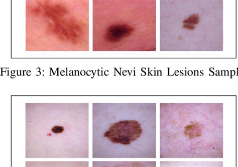 Figure 3 From Multi Modal Skin Lesion Classification Based On Dermoscopic Images And Meta Data