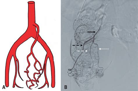 Scielo Brasil Angiographic Description Of The Superior Rectal Artery And Its Anatomical