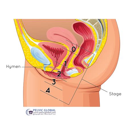 Understanding Pelvic Organ Prolapse And The Role Of Pelvic Floor
