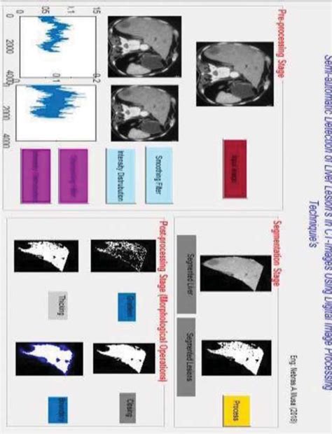 figure 11 from detection of ct liver lesions using otsu algorithm and
