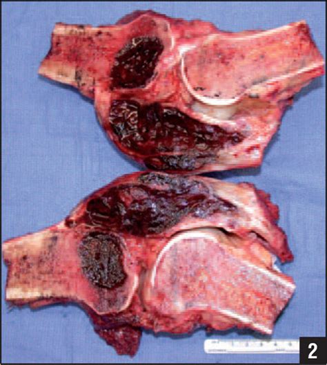 Telangiectatic Osteosarcoma Of The Patella Orthopedics