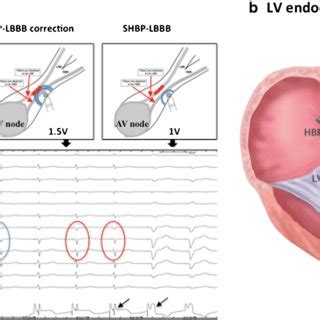 A His Bundle Pacing In A Patent With Left Bundle Branch Block Fibers Download Scientific