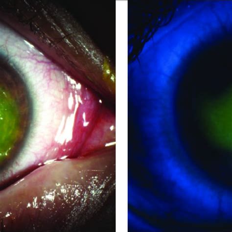 Corneal Epithelium On Postoperative Day 1 After Transepithelial Corneal Download Scientific