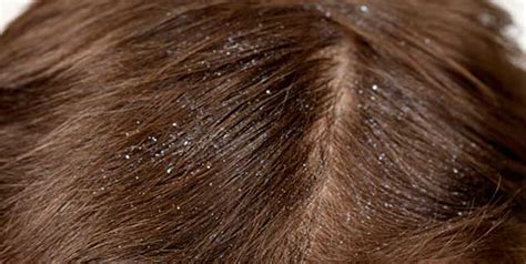 How To Get Rid Of Flaky Scalp Beauty Personal Care