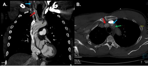 Figure 2 From Type A Aortic Dissection With Antegrade Intimointimal Intussusception Semantic