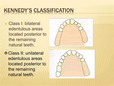 Introduction And Classification Of Removable Partial Denture Pptx