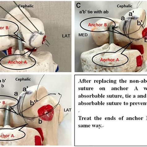 Schematic Diagram Of Surgical Process Download Scientific Diagram