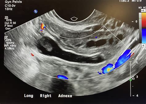 Appendicitis Seen On Transvaginal Ultrasound R Radiology