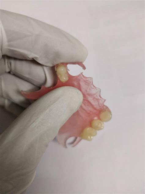 Affordable Flexible Valplast Customized Partial Denture Pink Valplast