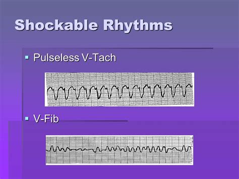V Fib Vs V Tach