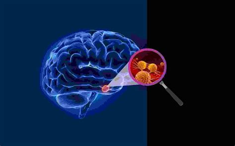 تومور مغزی معرفی متخصصین مغز و اعصاب در تهران ویستان