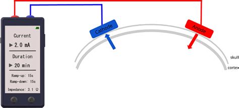 Tdcs For Treatment Resistant Depression Clinical Tree