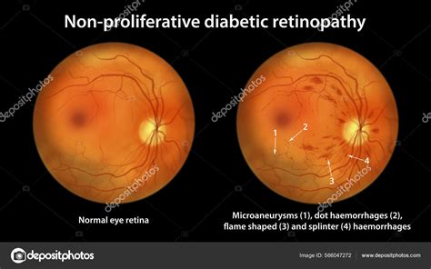 Non Proliferative Diabetic Retinopathy Illustration Showing Normal Eye