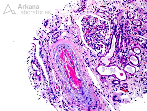 Thrombotic Microangiopathy Teaching Points Arkana Laboratories