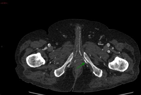 Penile Calciphylaxis A Conservative Approach Pmc