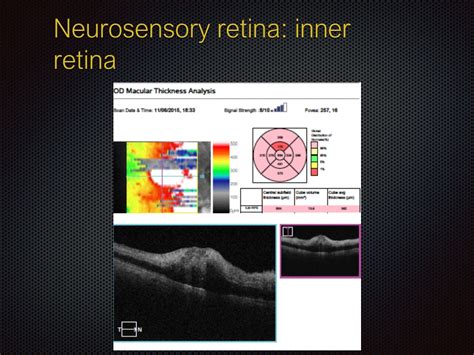 Ppt The Macula Oct An Overview Powerpoint Presentation Free