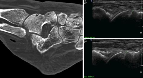 Sensitivity And Specificity Of Ultrasound In Detecting Osteo Chondral