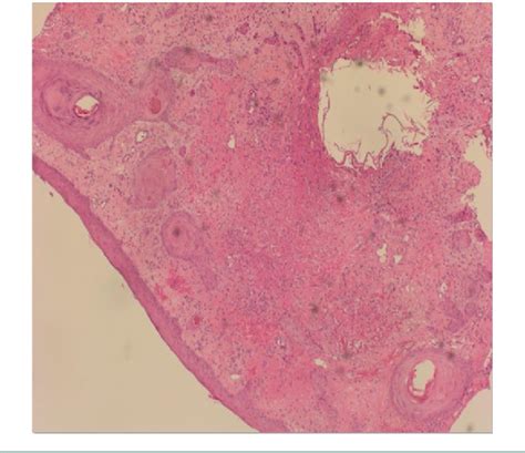 Figure 1 From First Presentation Of Pyoderma Gangrenosum In A Patient With Partial