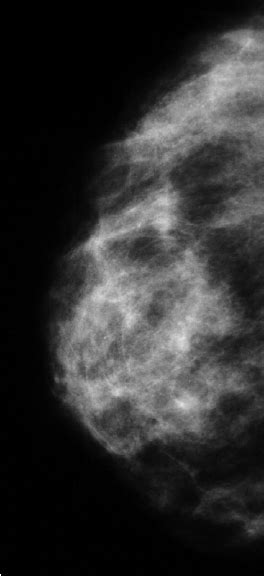 Dense Breast Normal Fibroglandular Tissue With Average Risk For