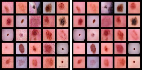 Table From Anomaly Detection For Skin Disease Images Using Variational Autoencoder Semantic