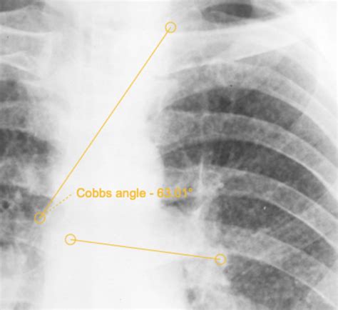 enhancement cobb angle callback function in configuration to add