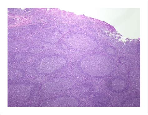Photomicrograph Of The Underlying Tonsil Shows Markedly Reactive Download Scientific Diagram