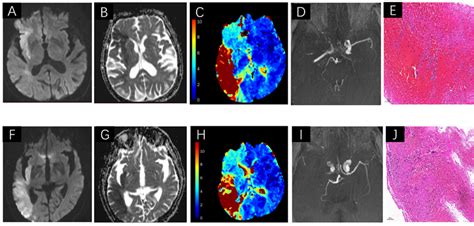 A Demonstration Of Thrombi Measurements On Dwi Adc Map Pwi Mra And Download Scientific