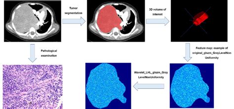 Example Of Tumor Segmentation The Patient An 8 Year Old Male With